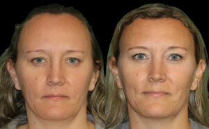 Forehead Reduction Before & Afters - Dr. Sahar Nadimi