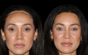 Forehead Reduction Before & Afters - Dr. Sahar Nadimi