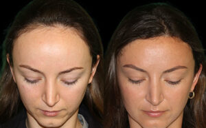 Forehead Reduction Before & Afters - Dr. Sahar Nadimi